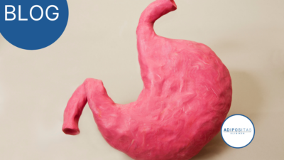 Reflux nach einer Schlauchmagen-Operation - Adipositas Kliniken